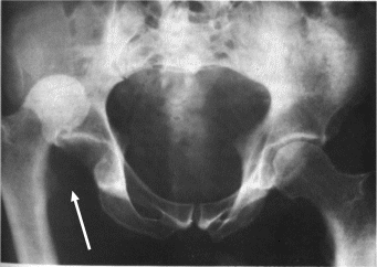 Tua Tagovailoa: Hip Dislocation & Acetabular Fracture – Dr. John M. Kunkel